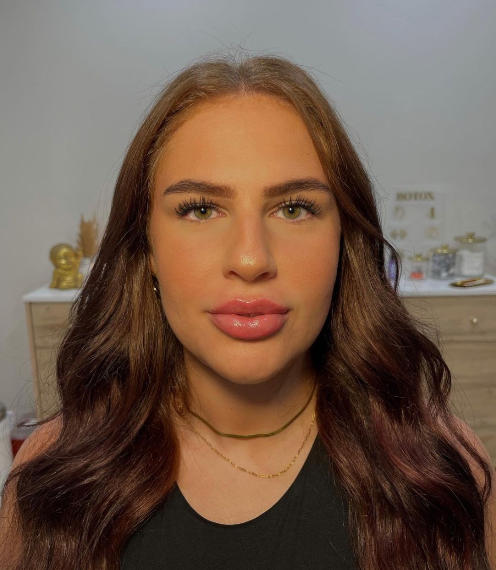 Lip Filler 